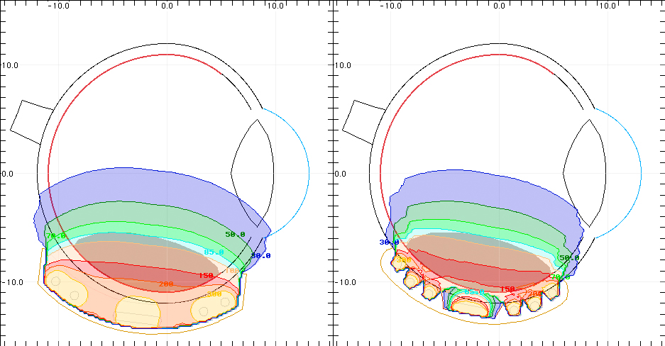 Eye Physics vs COMS Plaque