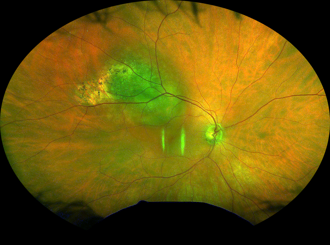 Imaging Requirements for Eye Physics Treatment Planning